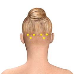 Botox Protocol for Migraine