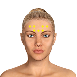 Botox Protocol for Migraine