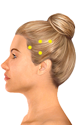 Botox Protocol for Migraine