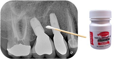 Q Tip Test for trigeminal neuralgia or peripheral neuropathy
