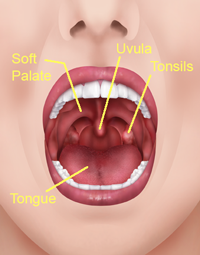 Mallampati Score to Help Predict Obstructive Sleep Apnea in Beverly Hills