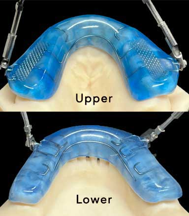 Mandibular Advancement Devices Snoring Nightguard