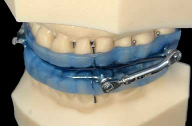 Mandibular Advancement Devices Snoring Nightguard