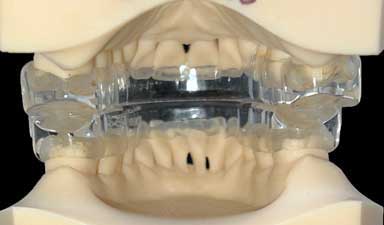Mandibular Advancement Devices Snoring Nightguard