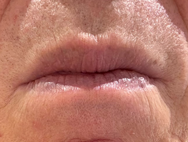 Mandibular Advancement Devices Snoring Nightguard