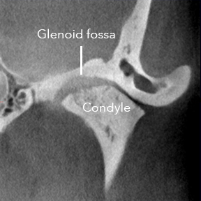 TMJ Radiology for Beverly Hills TMJ Osteoarthritis TMD TMJD